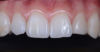 Novon® Technology - White Dental Beauty